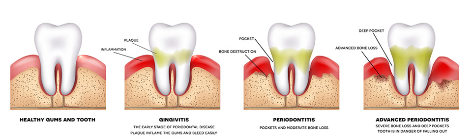 Catonsville, MD Periodontist - J. Fred Felton, DDS - Periodontist